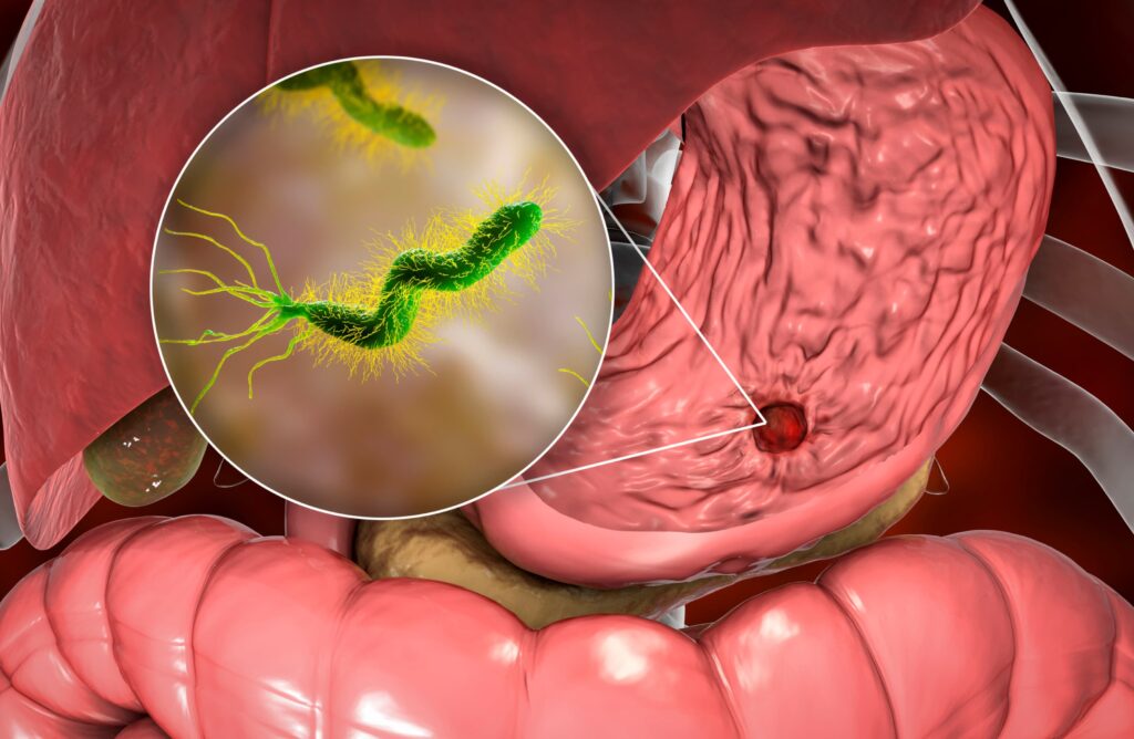 La bacteria helicobacter pylori y el riesgo de cáncer de estómago ...